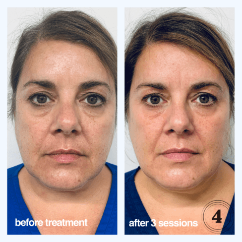 Plexr Soft Surgery For Eyes, Elgin, Scotland | Nichola Maasdorp No4 Clinic